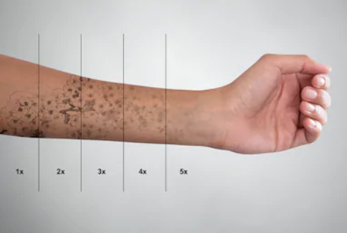 Skin Tag, Tattoo, Freckles, Warts, Mole Remover – SkinGenics ™ Online Shop